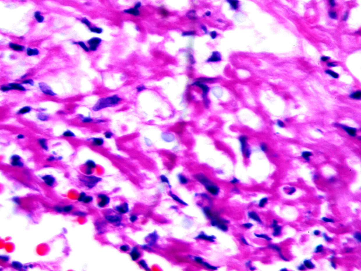 Ulceras por Criptococosis. Comportamiento en un paciente ...