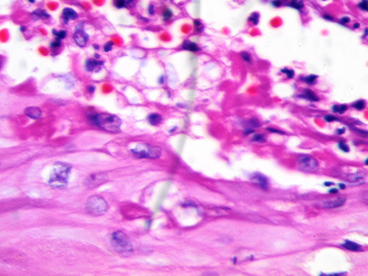 Ulceras por Criptococosis. Comportamiento en un paciente ...