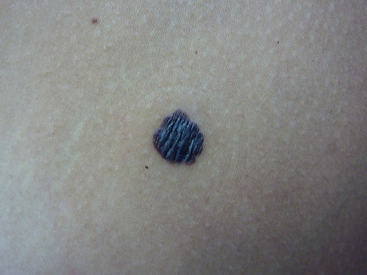 Caso Nº1 Ed.310: Melanoma nodular Vs. Nevo atípico – PIEL-L Latinoamericana