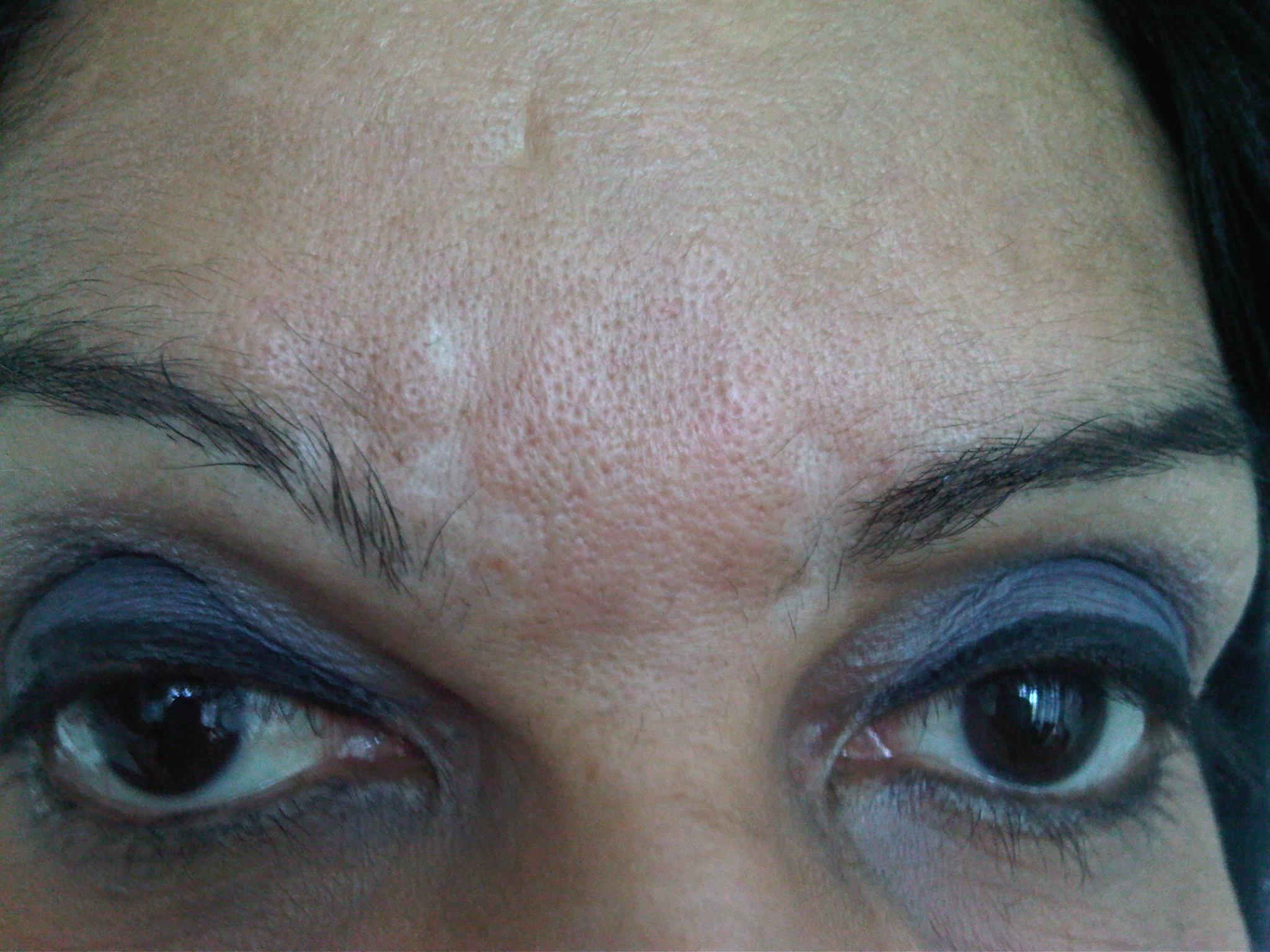 Caso Nº4 Ed.309: Dermatosis localizada en región supraciliar e ...