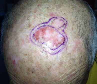 Dermatoscopia Edición 313 – PIEL-L Latinoamericana