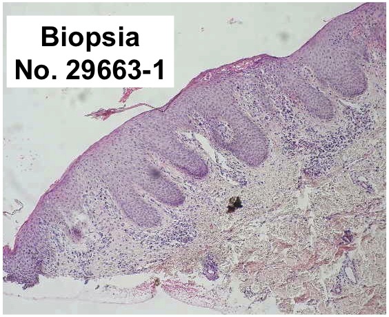 Caso semana: Parapsoriasis en placas – PIEL-L Latinoamericana