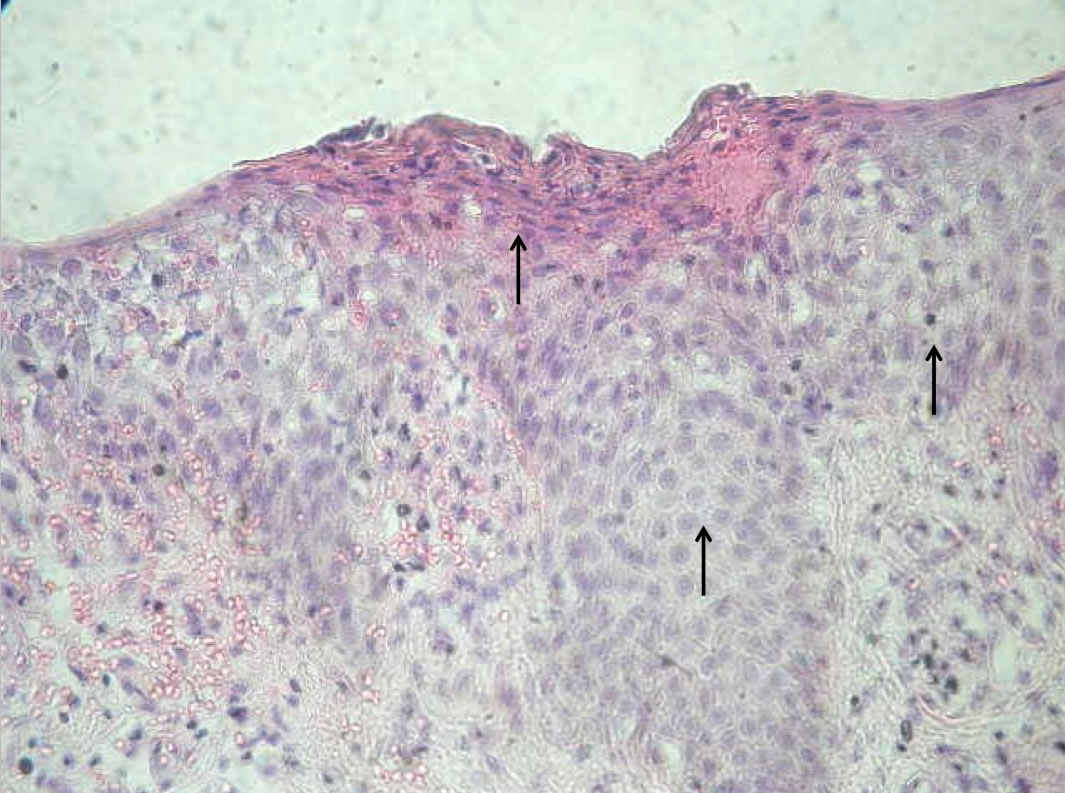 Caso semana: Parapsoriasis en placas – PIEL-L Latinoamericana