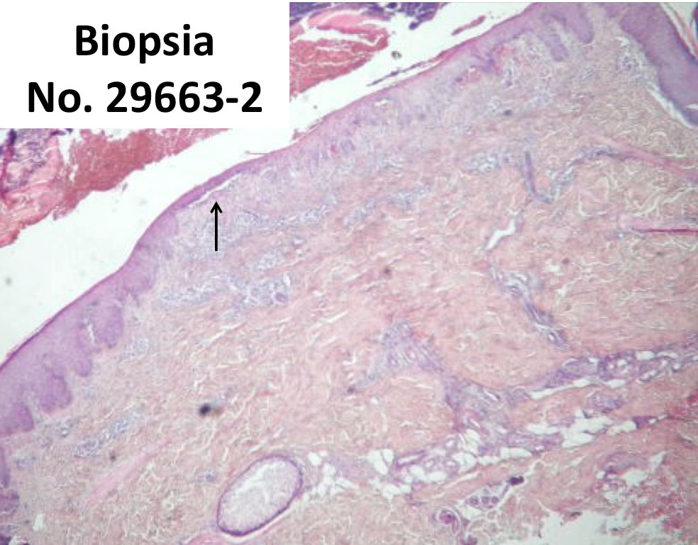 Caso semana: Parapsoriasis en placas – PIEL-L Latinoamericana