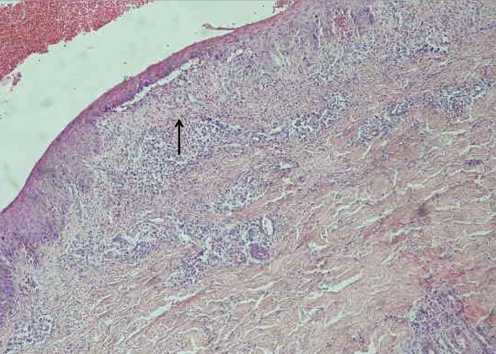 Caso semana: Parapsoriasis en placas – PIEL-L Latinoamericana