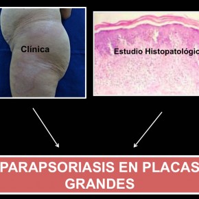 Caso semana: Parapsoriasis en placas – PIEL-L Latinoamericana