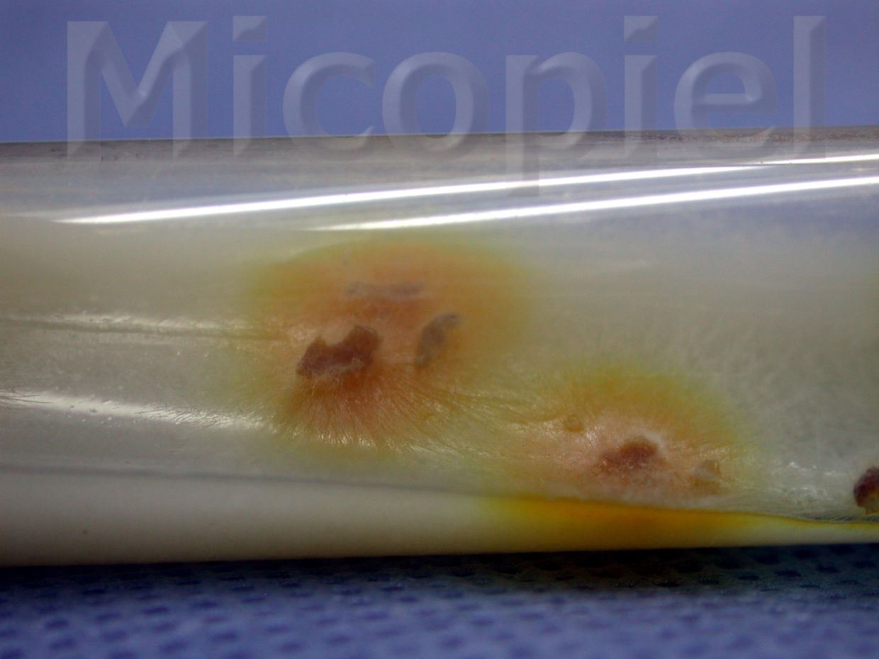 Caso Clínico Nº 56. Tiña en Paciente Inmunosuprimida – PIEL-L ...