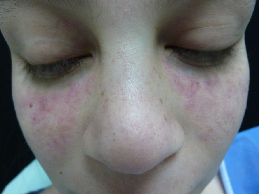 Caso Nº3 Ed.313: Dermatitis perivascular superficial y profunda – PIEL ...