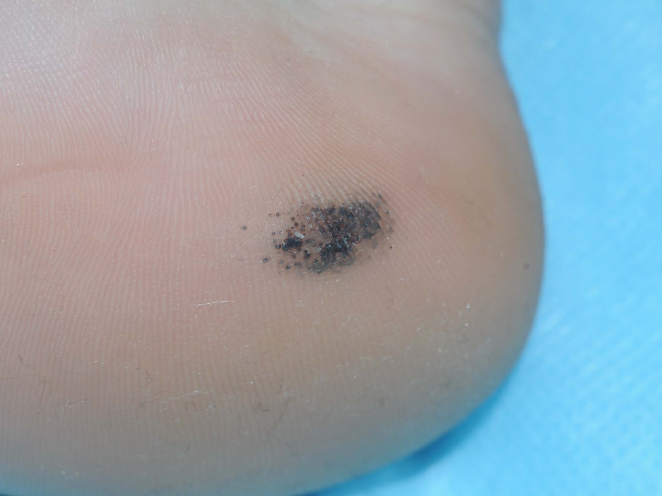 «Melanoma maligno» en el talón – PIEL-L Latinoamericana