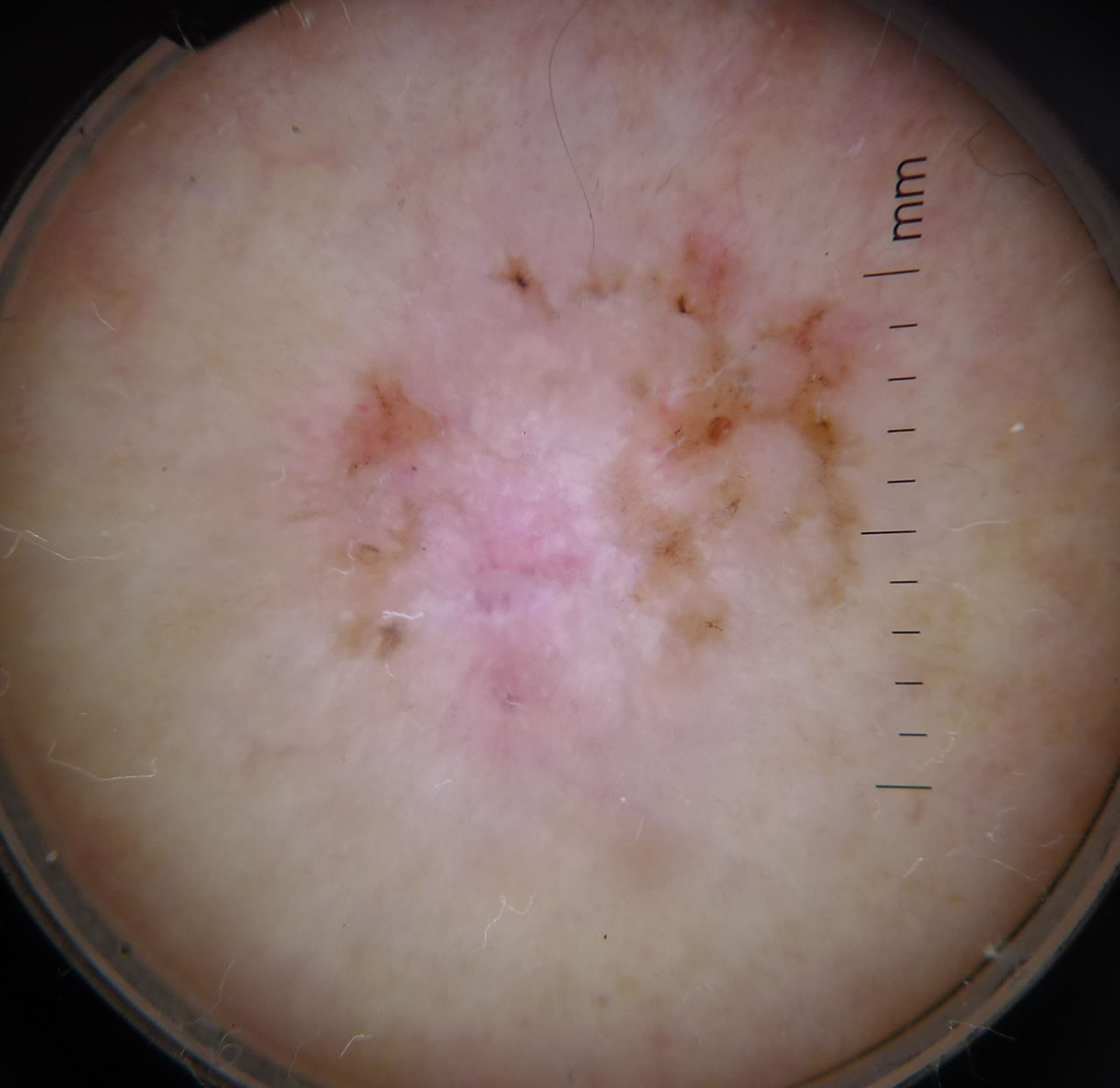 Dermatoscopia Edición 316 – PIEL-L Latinoamericana