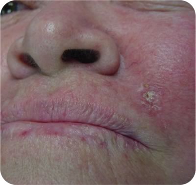 Caso Nº3 Ed.317: Colgajo romboidal de Limberg y sus variantes – PIEL-L ...