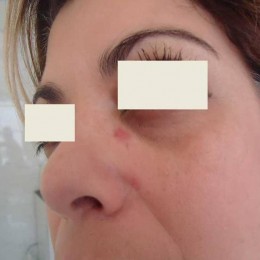 Lesões papulosas face de coloração amarelada – PIEL-L Latinoamericana