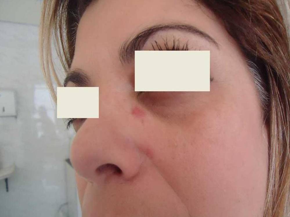 Lesões papulosas face de coloração amarelada – PIEL-L Latinoamericana