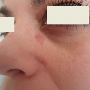 Lesões papulosas face de coloração amarelada – PIEL-L Latinoamericana