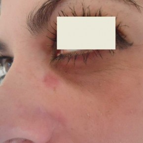 Lesões papulosas face de coloração amarelada – PIEL-L Latinoamericana