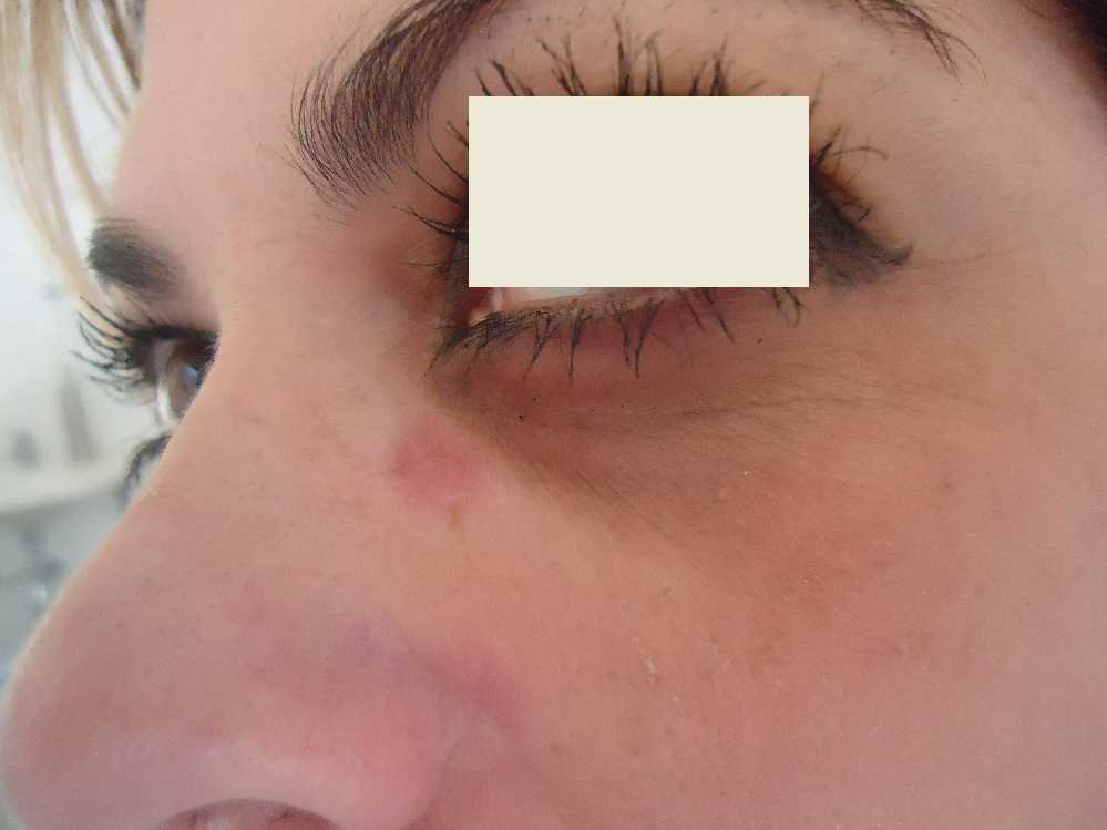 Lesões papulosas face de coloração amarelada – PIEL-L Latinoamericana