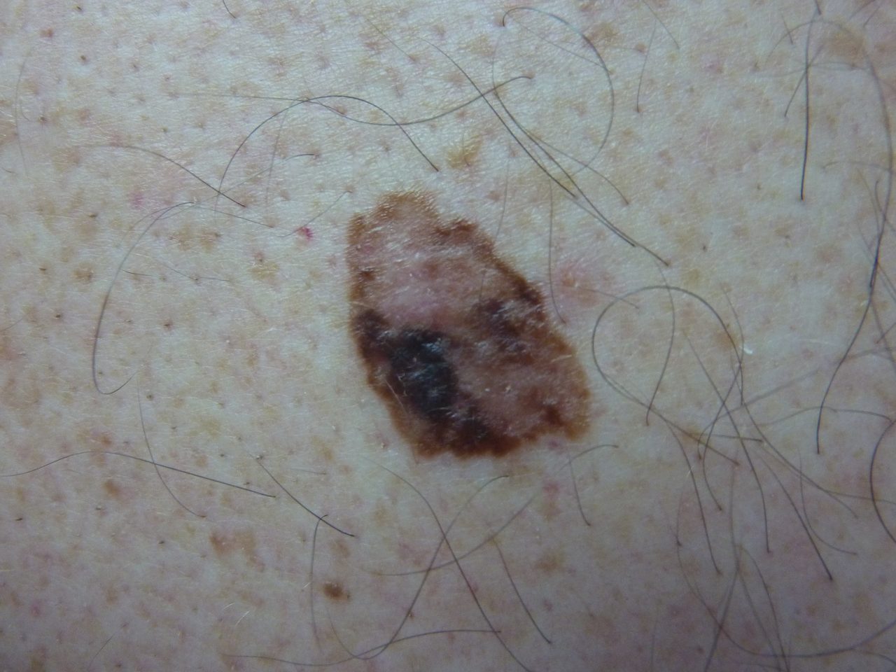 Caso No.4 Ed.319: Melanoma in situ adyacente a nevo displásico de unión ...