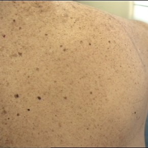 Lesoes circinadas pelo abdomen, que recidivam – PIEL-L Latinoamericana