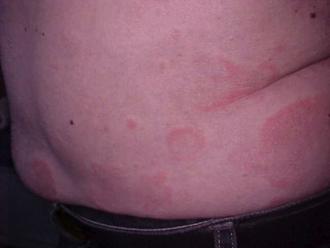 Lesoes circinadas pelo abdomen, que recidivam – PIEL-L Latinoamericana