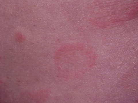 Lesoes circinadas pelo abdomen, que recidivam – PIEL-L Latinoamericana