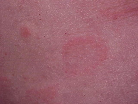Lesoes circinadas pelo abdomen, que recidivam – PIEL-L Latinoamericana