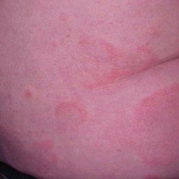 Lesoes circinadas pelo abdomen, que recidivam – PIEL-L Latinoamericana