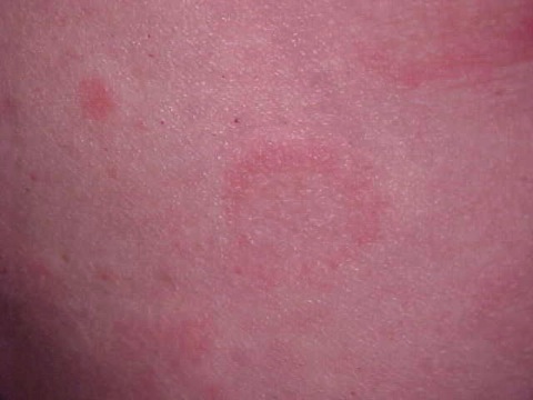 Lesoes circinadas pelo abdomen, que recidivam – PIEL-L Latinoamericana