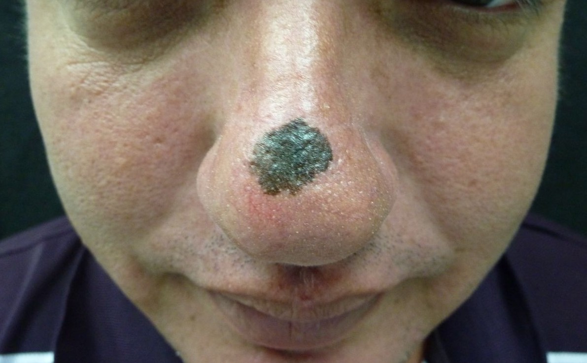 Caso No.1 Ed. 321: Mancha o mácula negra, redonda de 1.2 cm de diámetro ...