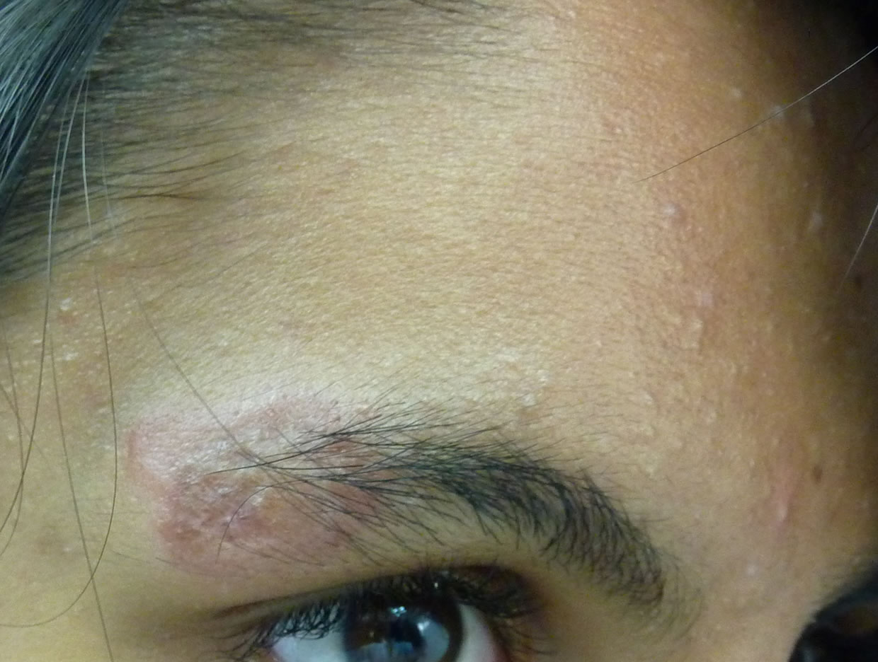 Caso clínico Nº2 Ed.324: Placa redondeada localizada en piel de la cola ...