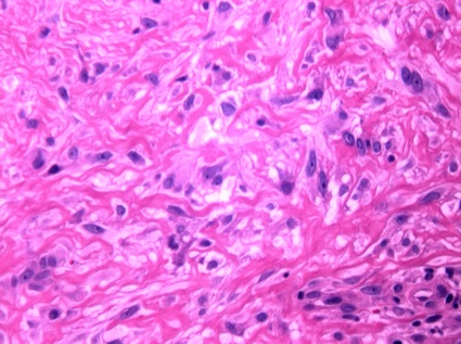 Caso Clínico Nº1 Ed.326: Xantomas cutáneos.. Cómo manejarlo – PIEL-L ...