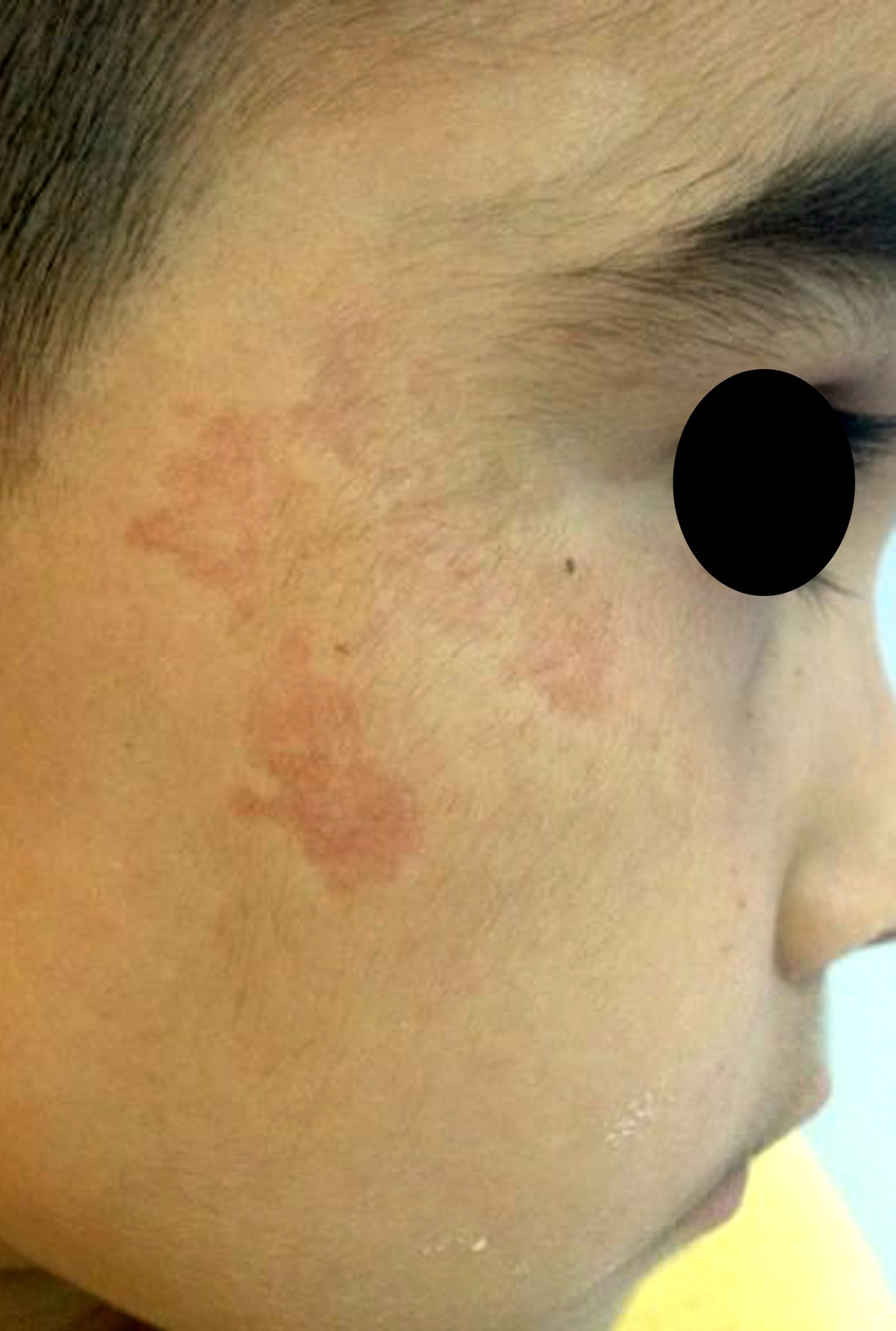 Caso clínico Nº 60. Dermatofitosis en Cara – PIEL-L Latinoamericana