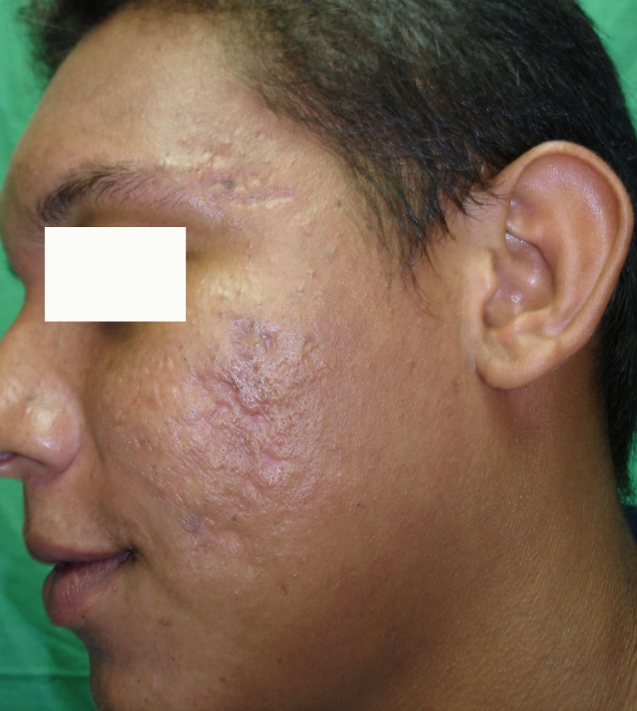 Acné inflamatorio activo moderado a severo desde la edad de 10 años ...