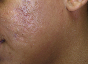 Acné inflamatorio activo moderado a severo desde la edad de 10 años ...