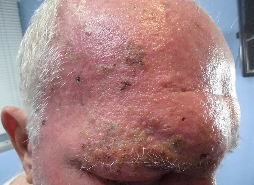 Caso Nº1 Ed.331: Herpes Zoster – PIEL-L Latinoamericana