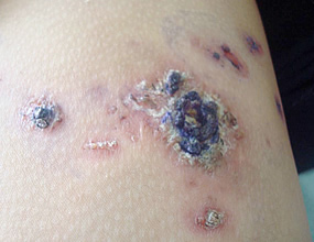 Reporte de Caso Clinico: Botriomicosis – PIEL-L Latinoamericana