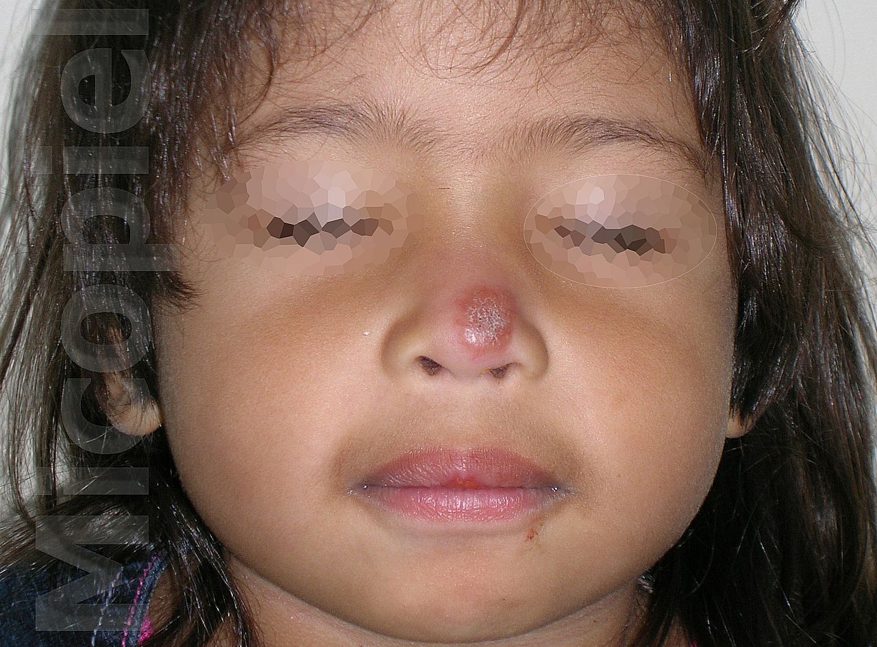 Caso Clínico Nº 61 – PIEL-L Latinoamericana