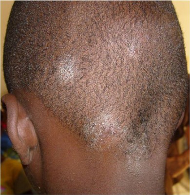 Tineacapitis. Emergenciade Microsporum audouinii y Trichophyton ...