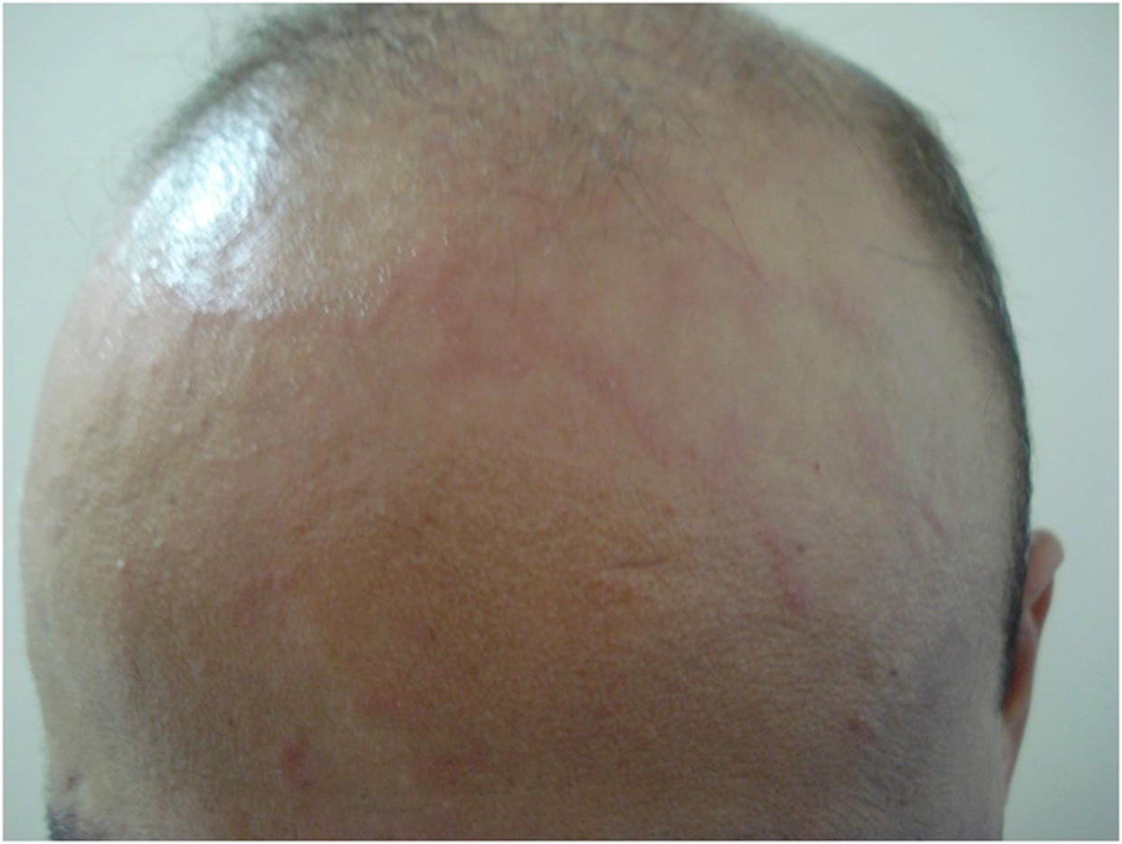 Larva migrans cutánea en rostro – PIEL-L Latinoamericana