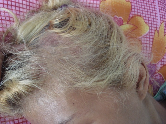 Caso Nº1. Ed.38: Tinea capitis por microsporum canis en paciente con ...