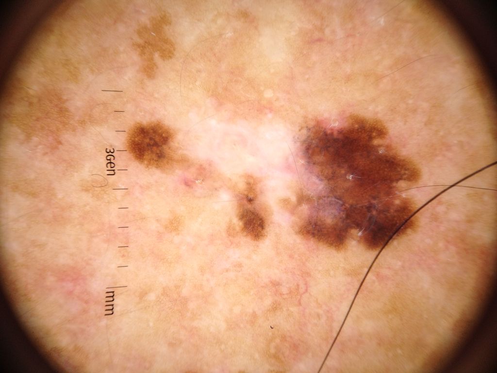 Dermatoscopia Ed.342 – PIEL-L Latinoamericana