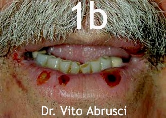 Angiomas venosos de los labios tratados mediante tecnicas combinadas ...