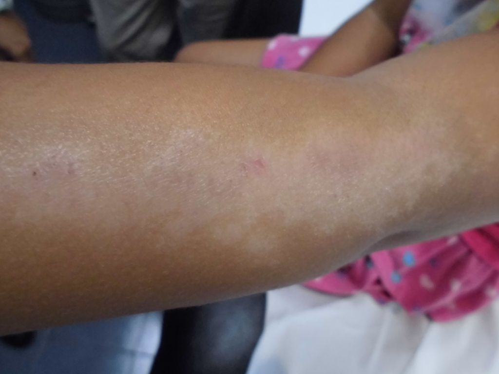 Caso No.5 Ed.344: Niña de 5 años, atópica, con lesiones lineales ...