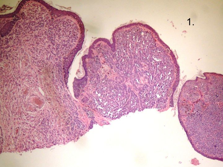 Nevus de Unna y melanoma maligno. A propósito de un caso – PIEL-L ...