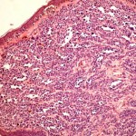 Nevus de Unna y melanoma maligno. A propósito de un caso – PIEL-L ...