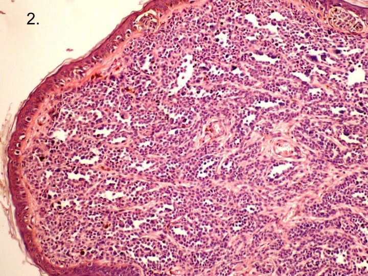 Nevus de Unna y melanoma maligno. A propósito de un caso – PIEL-L ...