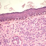 Nevus de Unna y melanoma maligno. A propósito de un caso – PIEL-L ...