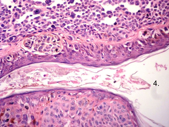 Nevus de Unna y melanoma maligno. A propósito de un caso – PIEL-L ...