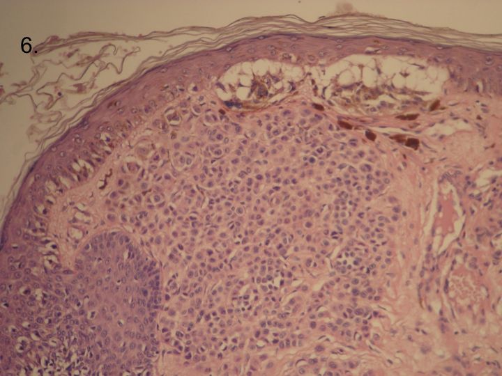 Nevus de Unna y melanoma maligno. A propósito de un caso – PIEL-L ...