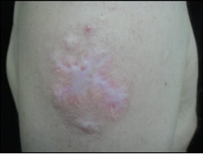 Pioderma Gangrenoso como manifestación inicial de Enfermedad ...