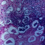 Síndromes de necrosis cutanea: un reto en la consulta del dermatólogo ...